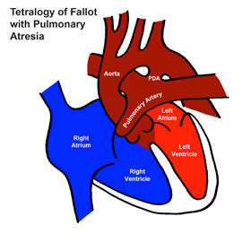Congenital Heart Diseases - Department of Pediatrics
