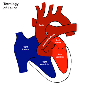 Congenital Heart Diseases - Department of Pediatrics