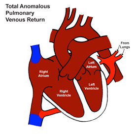 Congenital Heart Diseases - Department of Pediatrics